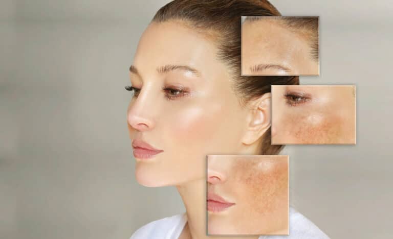 Melasma and Pigment Fading Treatments - Cosmetic Clinic Perth | Skin ...