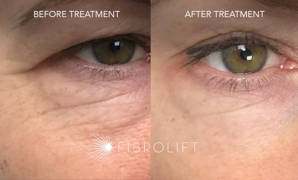 Anti Wrinkle Injections Perth | Anti Wrinkle Treatment Perth | Skin Resus